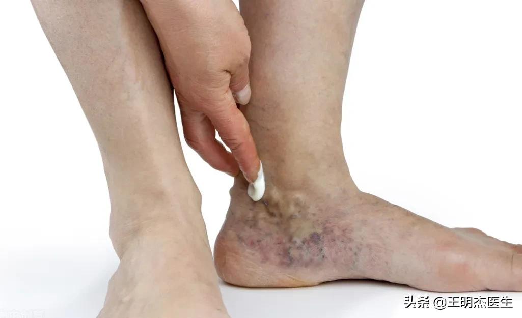 What are the symptoms of old rotten legs in different periods? - iMedia