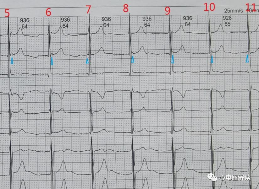 Accelerated ventricular rhythm - iMedia