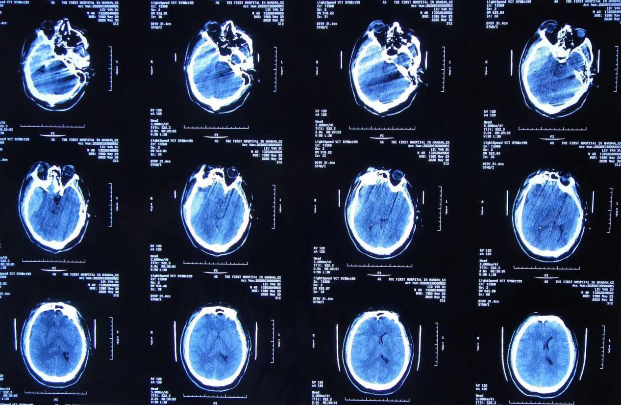Subdural effusion and encephalocele after traumatic brain injury, two ...