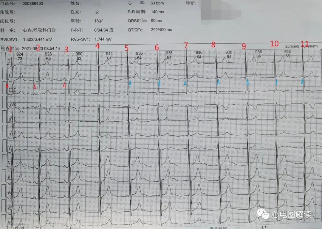 Accelerated ventricular rhythm - iMedia