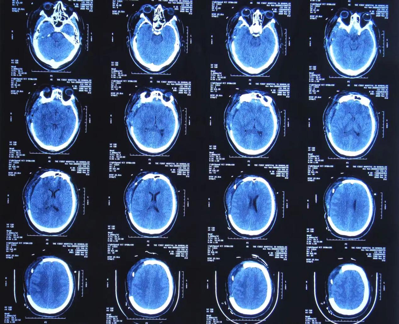 Subdural effusion and encephalocele after traumatic brain injury, two ...