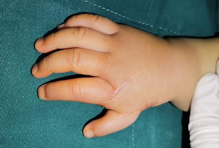 Is there a need for surgery for floating hallux deformity? - iMedia