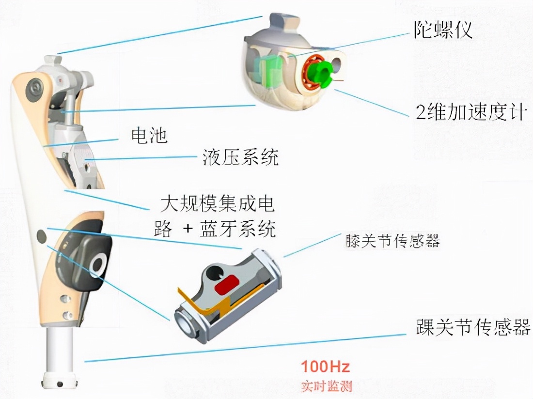 What is a smart prosthesis - iMedia