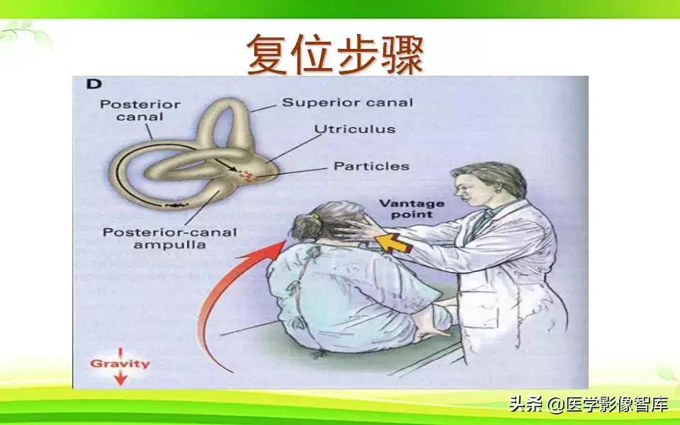 How to differentiate and diagnose "central positional vertigo" that is ...