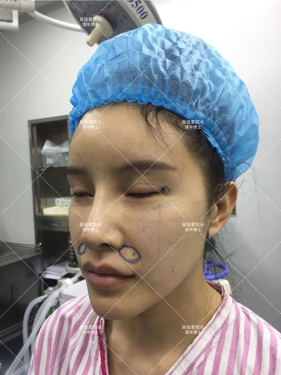 5 months after the small face lift, how did she recover at the age of ...