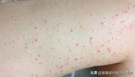 What kind of disease is purpura?What are the initial symptoms?Pictures ...