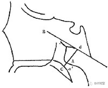 4 methods to measure "adenoid hypertrophy" by X-ray - iMedia