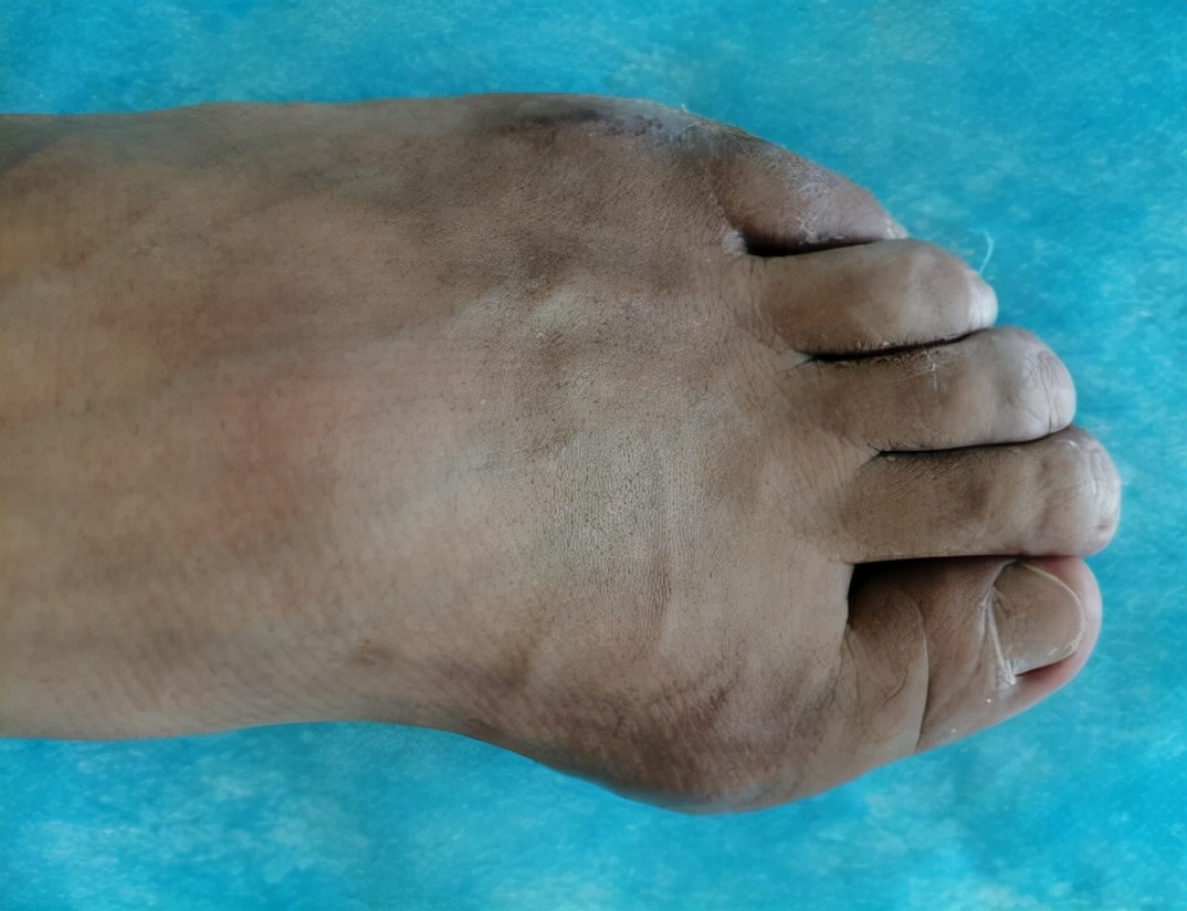 Surgical removal of tophi, the treatment process of one of my gout ...