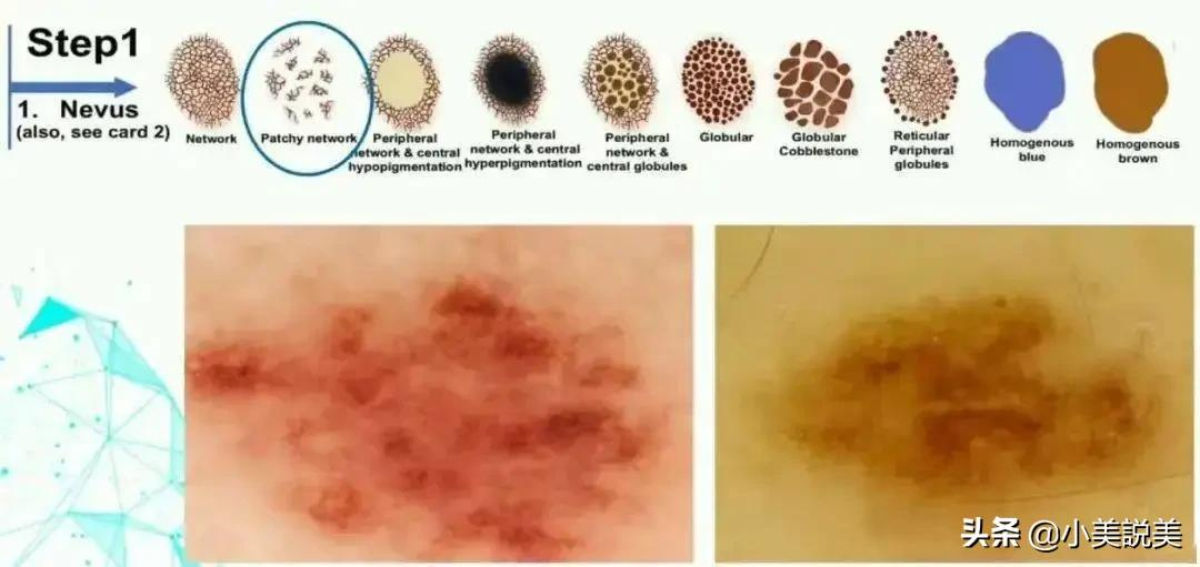 What can I do to get moles - iMedia
