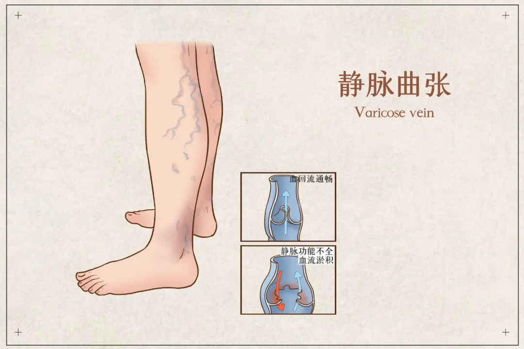 Varicose veins are not painful or itchy, but they should also be taken ...