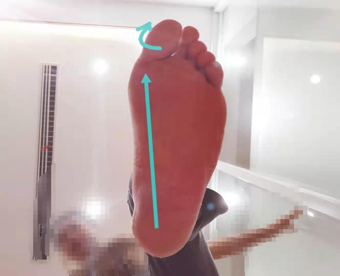 Big toe valgus causes stout legs and improper leg shape!Learn this ...