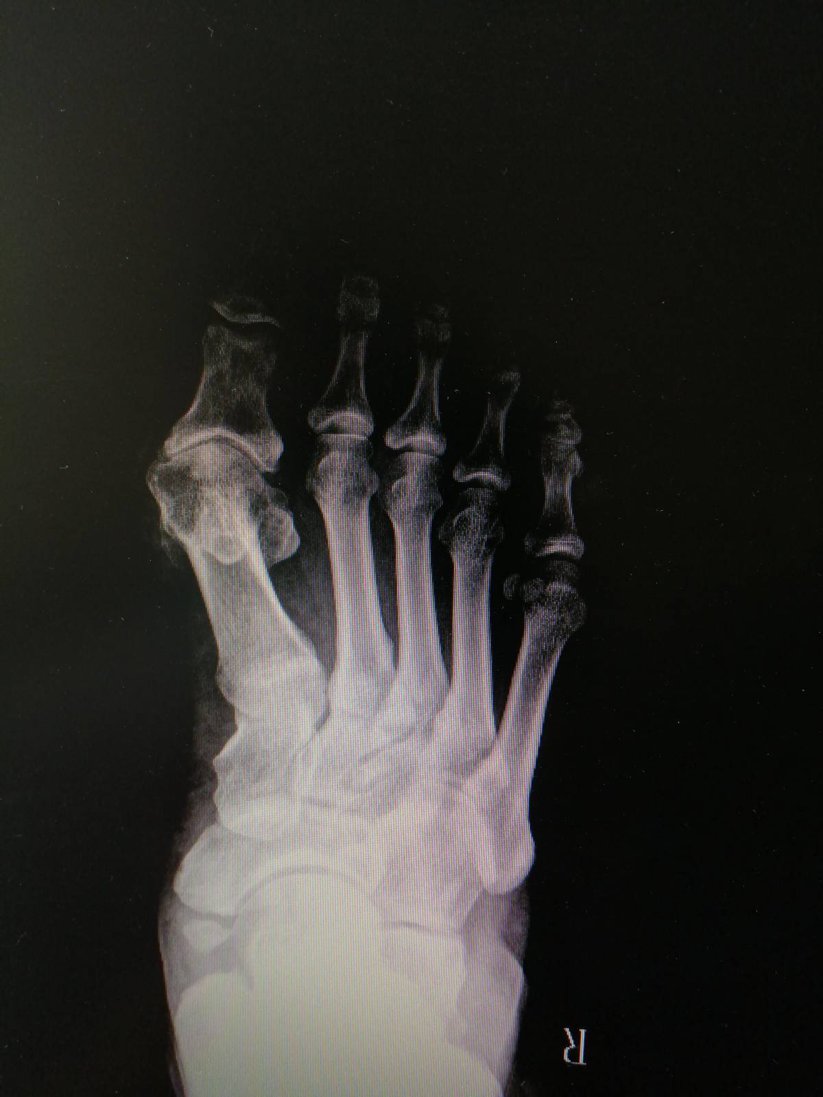 Surgical removal of tophi, the treatment process of one of my gout ...