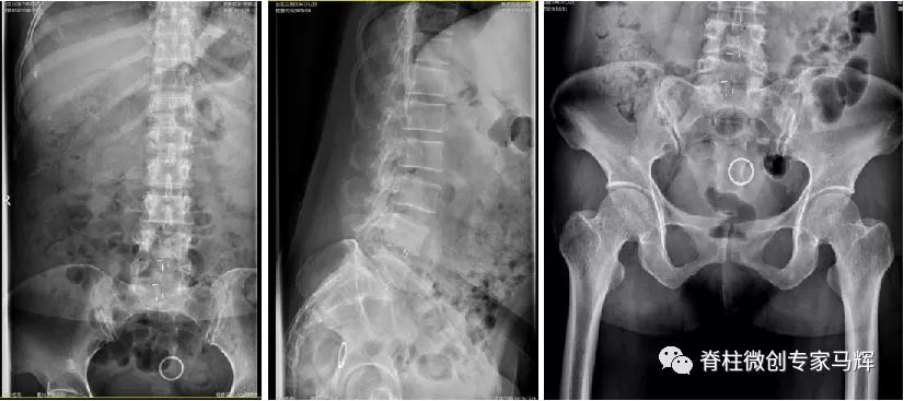 Fever, low back pain, weakness of lower limbs, beware of intraspinal ...