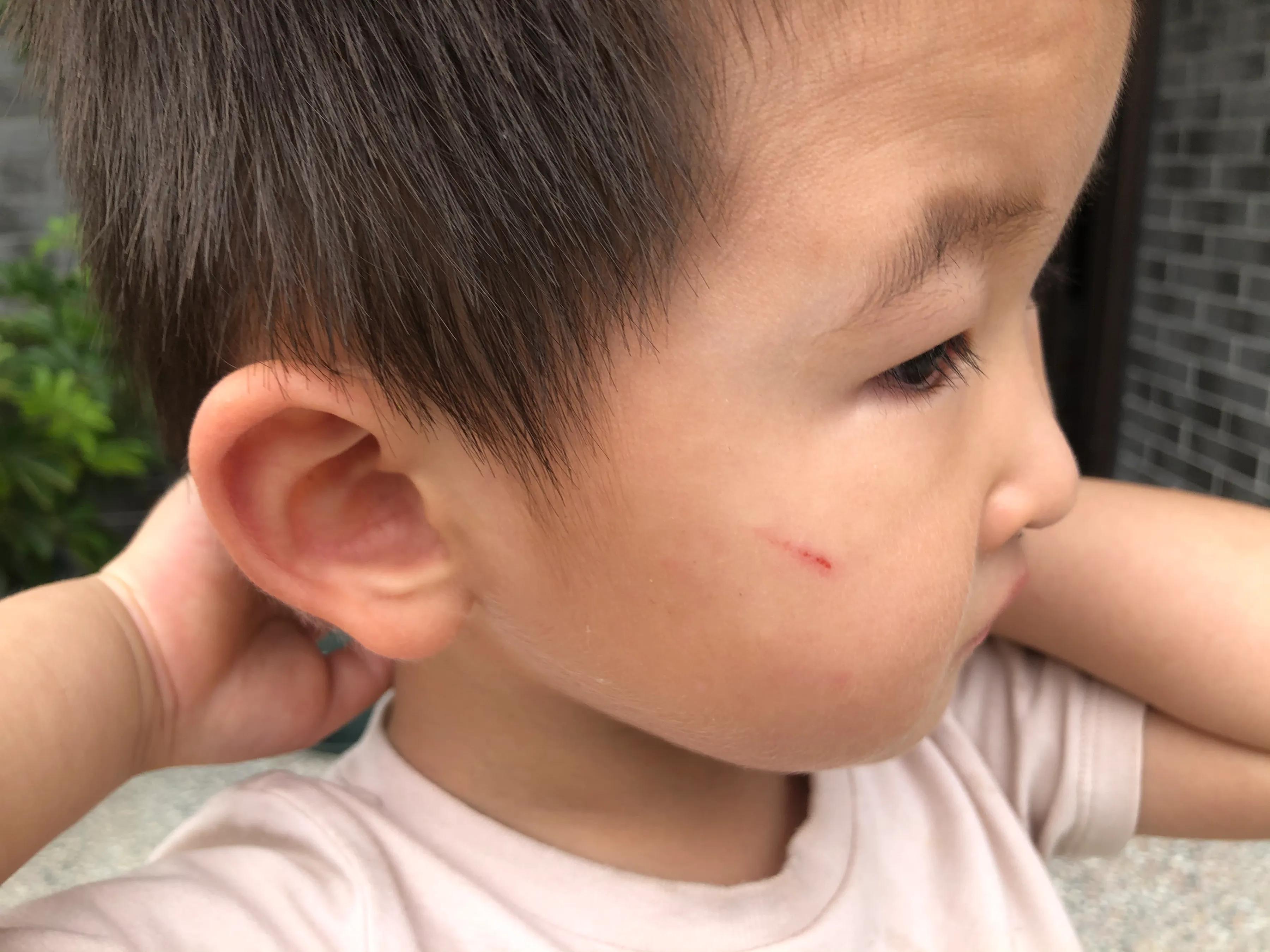 Bumps and bumps are always inevitable, a little skin trauma, don't care ...