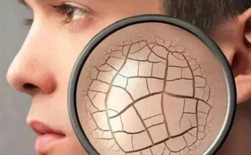 Vitiligo Always Repeats Itself Because You Can t Get Rid Of These Habits IMedia vitiligo-always-repeats-itself-because-you-can-t-get-rid-of-these-habits-imedia