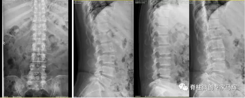 Fever, low back pain, weakness of lower limbs, beware of intraspinal ...