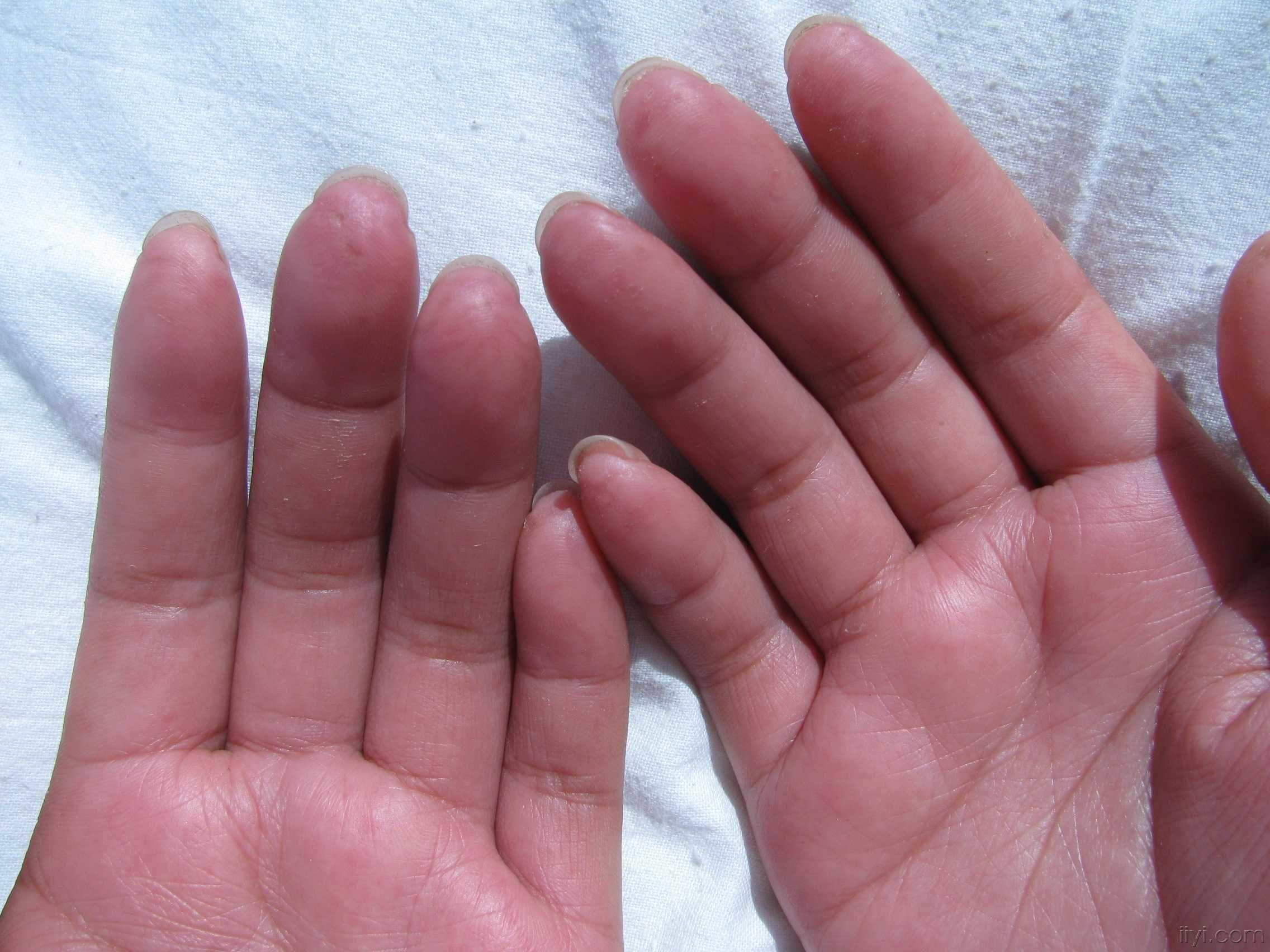 Systemic sclerosis, also known as scleroderma, the patient's skin ...