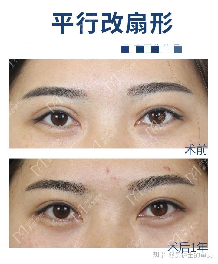 Why is the arc of the tail of the eye drooping after the operation of ...