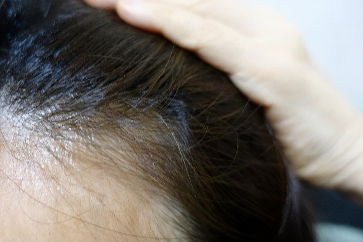 White hair at a young age?White hair grows on the forehead, temples ...