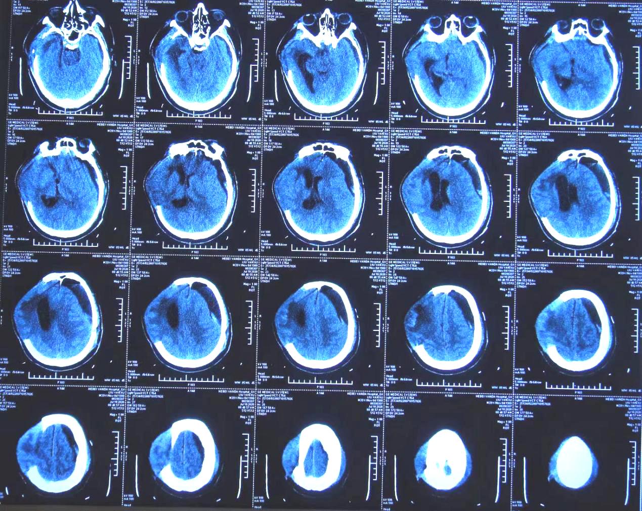 Subdural effusion and encephalocele after traumatic brain injury, two ...