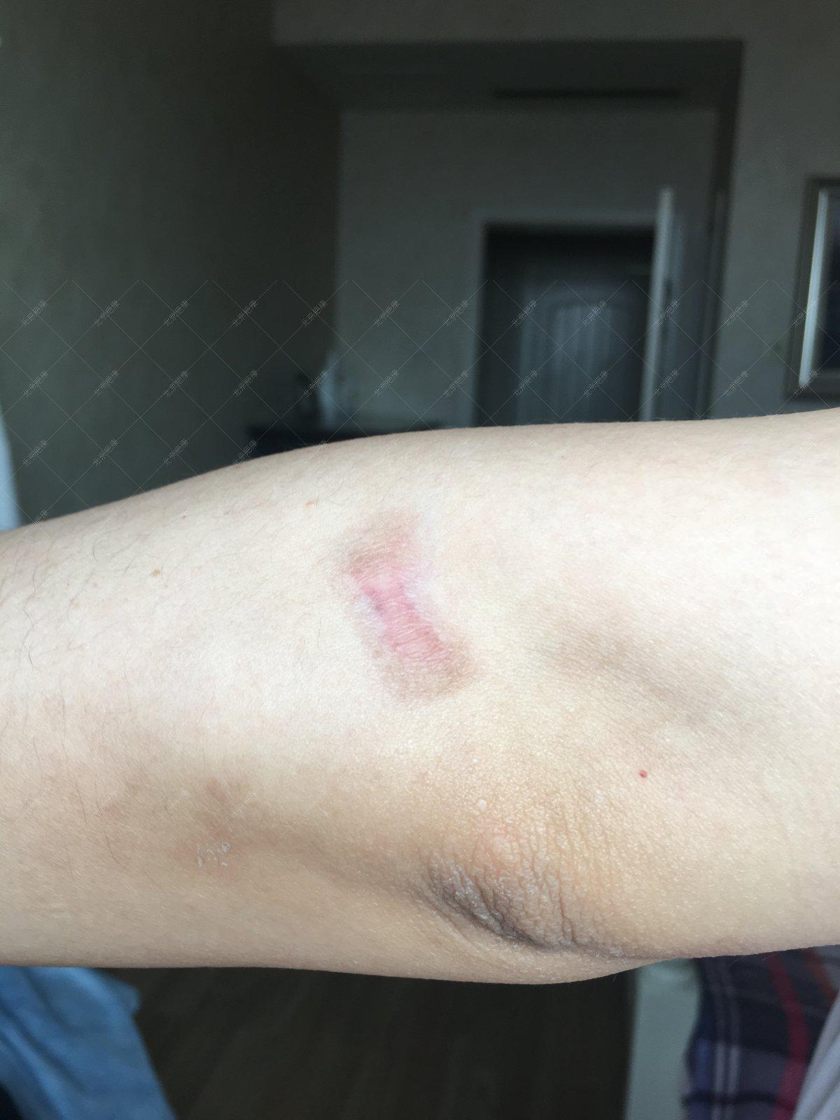 (Scar Kang) I broke my elbow, and my scar grew. - iMedia