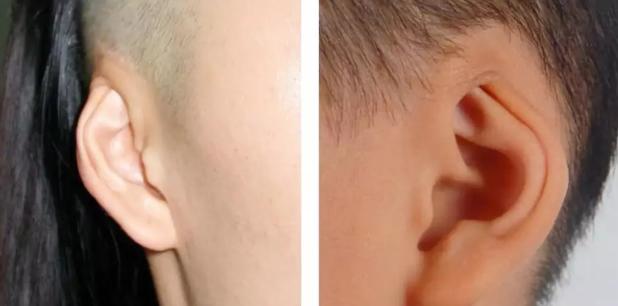 Treatment of congenital ear deformities: how to correct hidden ears ...