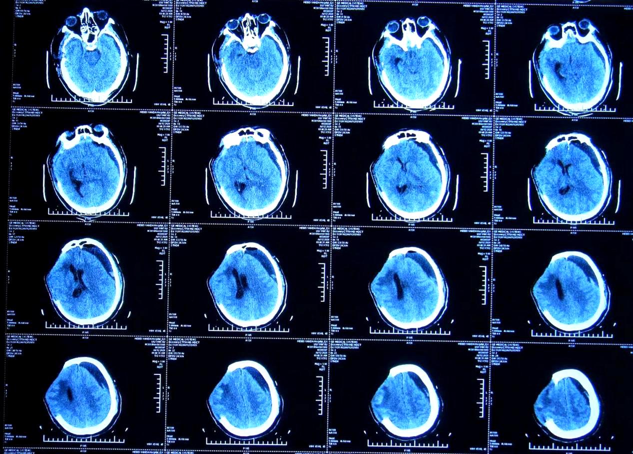 Subdural effusion and encephalocele after traumatic brain injury, two ...