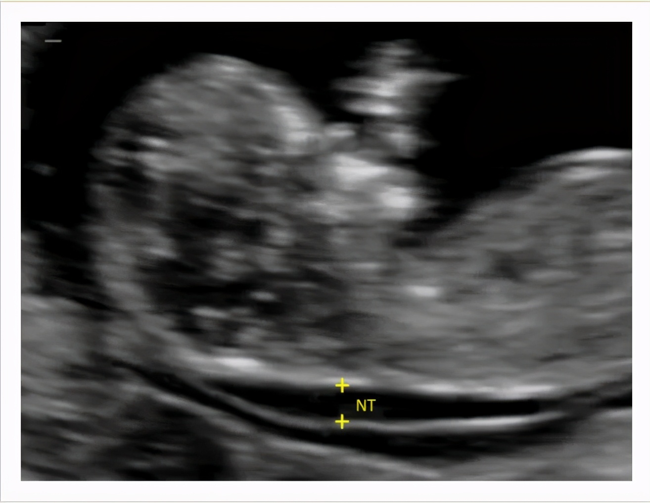 Can the NT check tell the baby's gender?Thousands of others are also ...