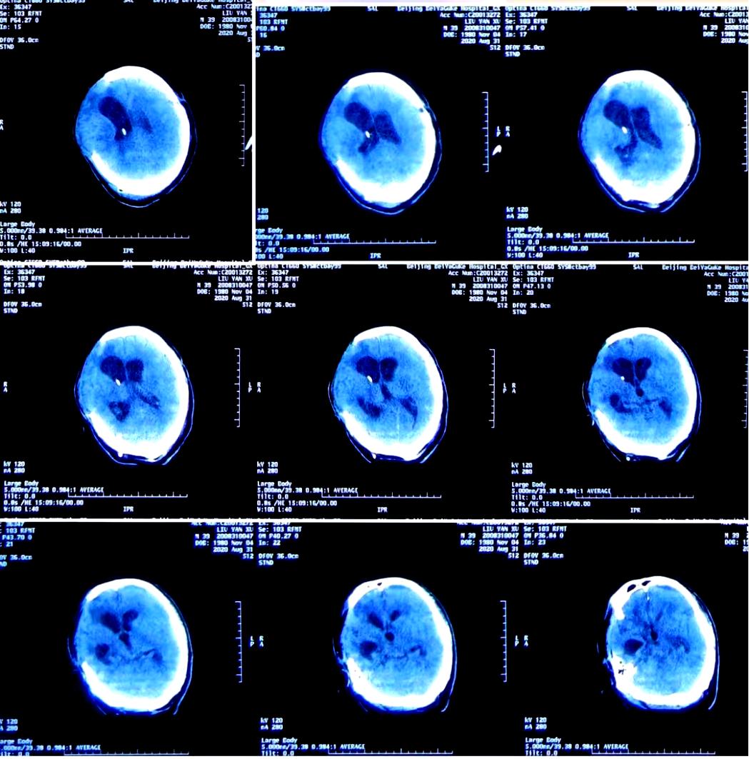 Subdural effusion and encephalocele after traumatic brain injury, two ...