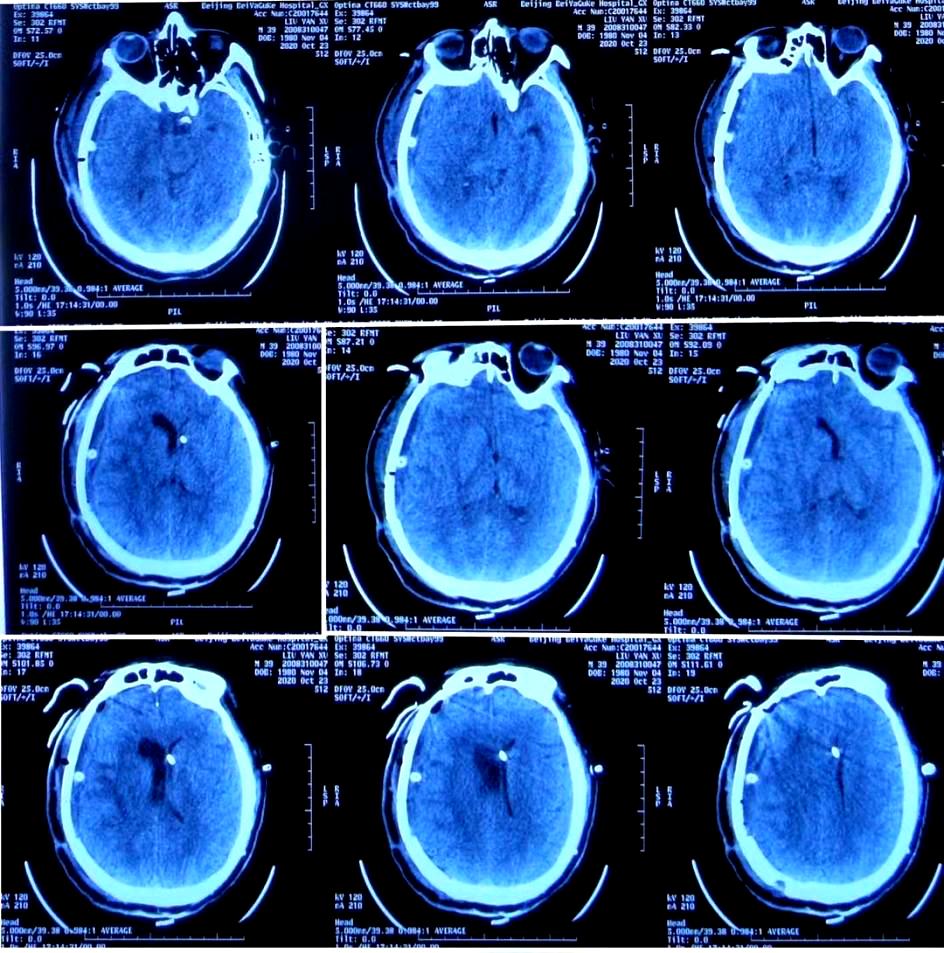 Subdural effusion and encephalocele after traumatic brain injury, two ...