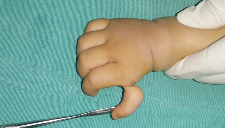 Is there a need for surgery for floating hallux deformity? - iMedia