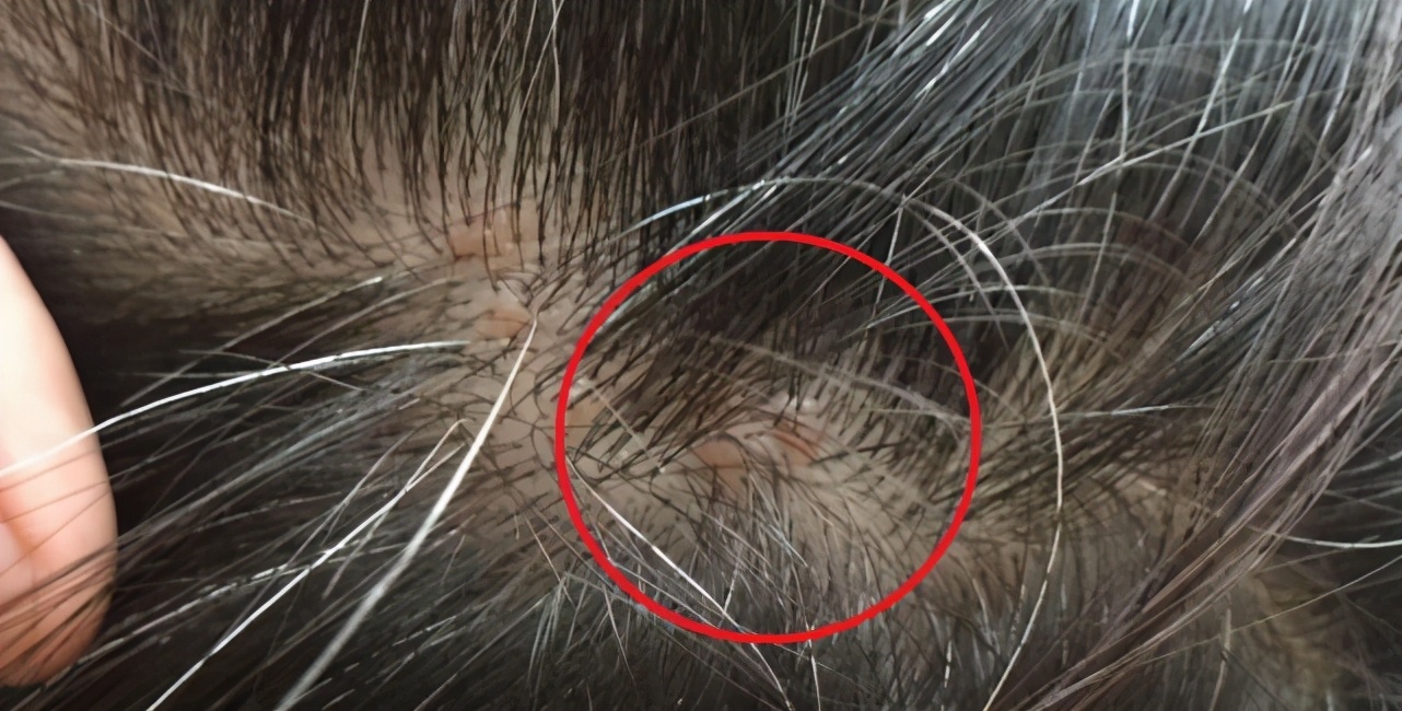 What does a small pustule on the scalp indicate? - iMedia