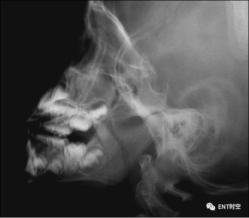 4 methods to measure "adenoid hypertrophy" by X-ray - iMedia