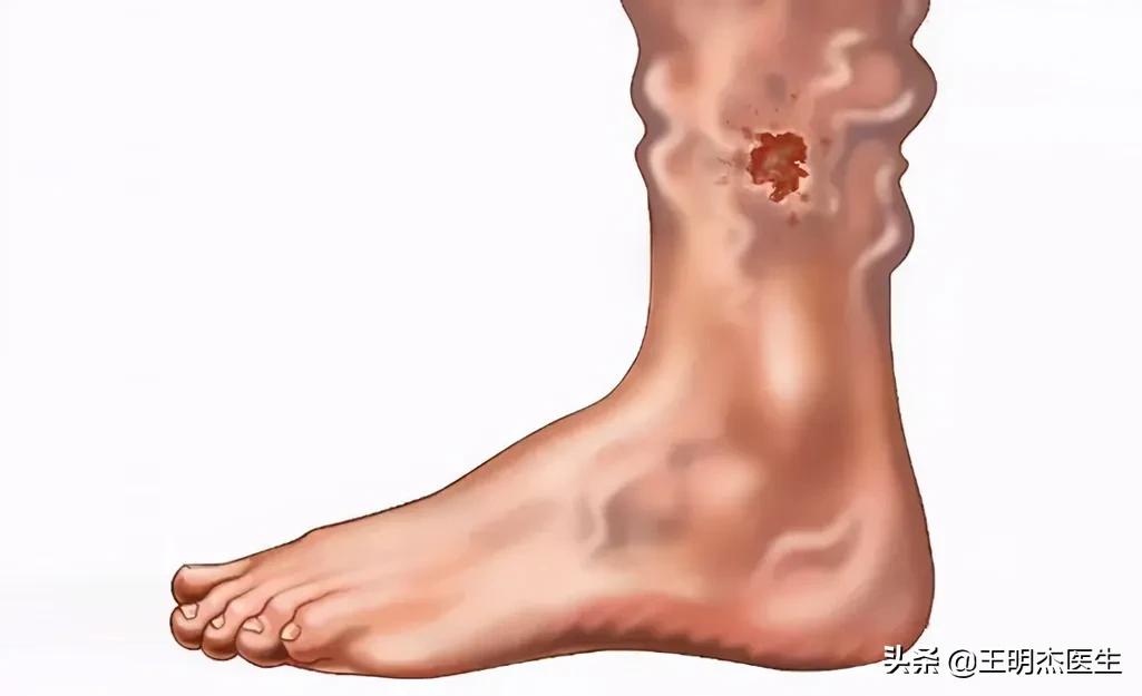 What are the symptoms of old rotten legs in different periods? - iMedia