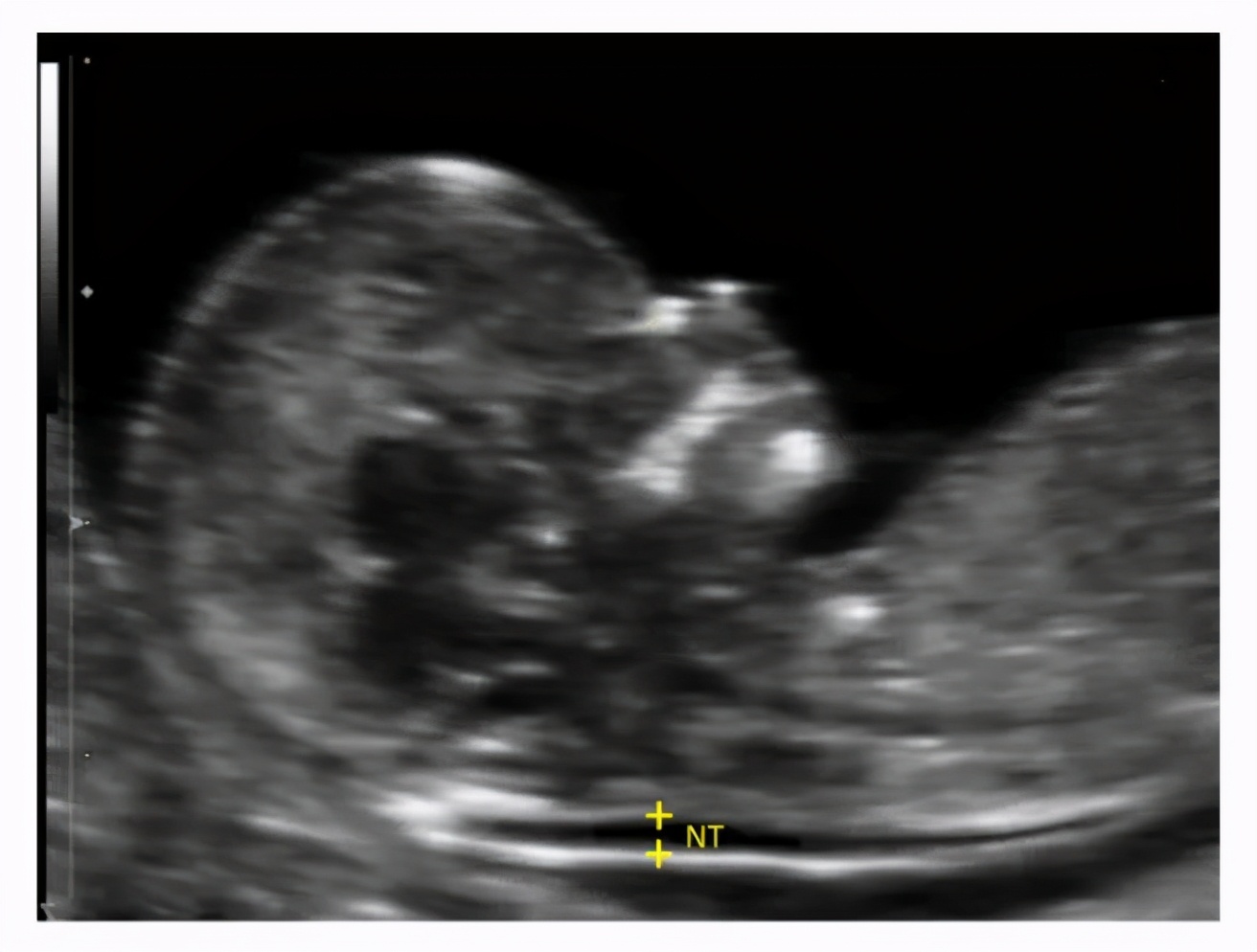 Can the NT check tell the baby's gender?Thousands of others are also ...