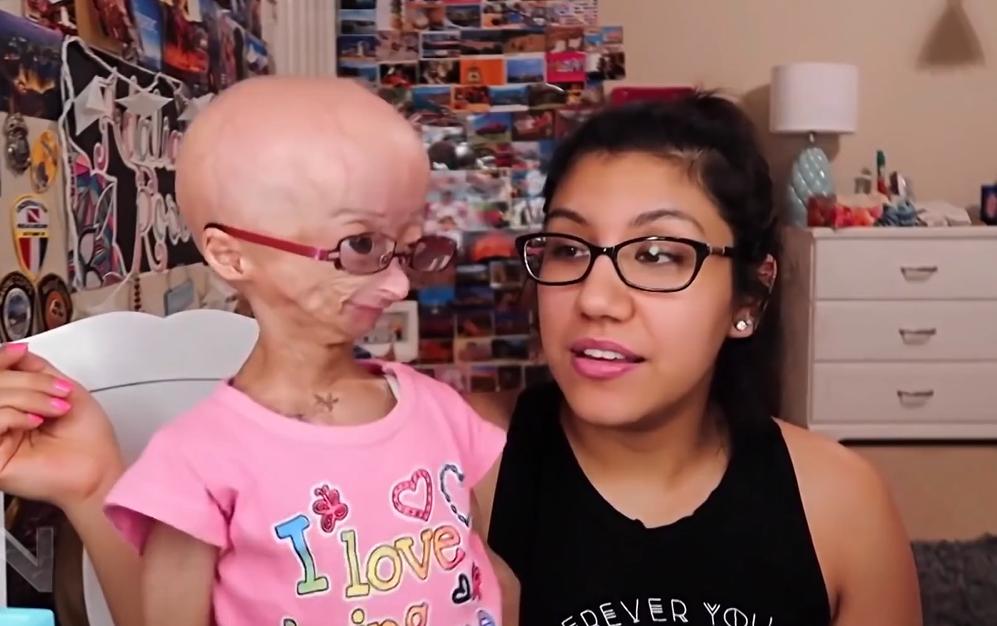 The girl suffers from progeria, looks like an alien, but is a big star ...