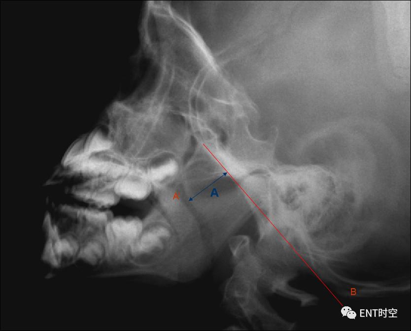 4 methods to measure "adenoid hypertrophy" by X-ray - iMedia