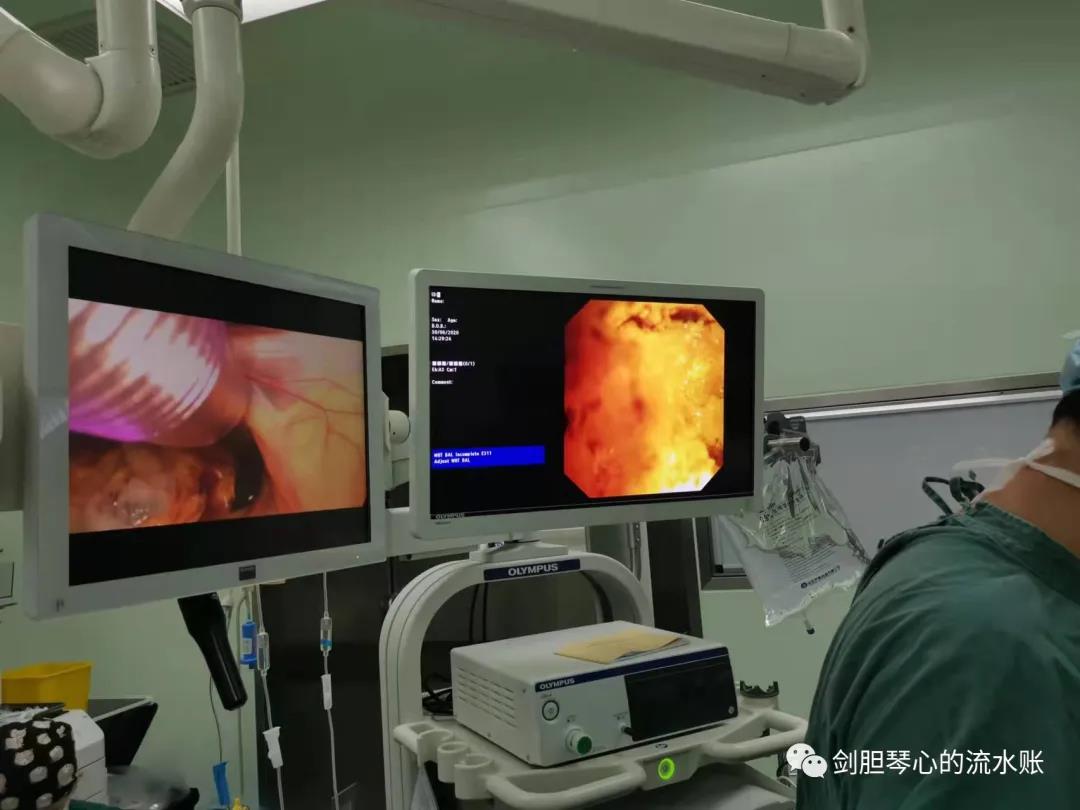 What is a choledochoscope? - iMedia