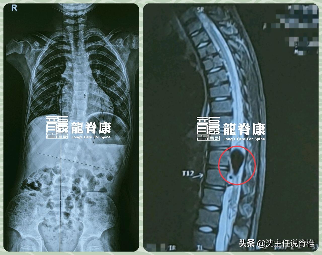 Repeated low back and leg pain, lower extremity weakness and scoliosis ...