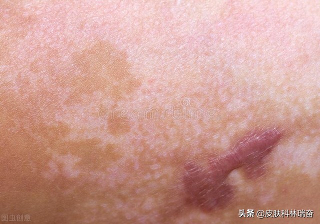 Six common types of scars, come and see which one do you belong to ...