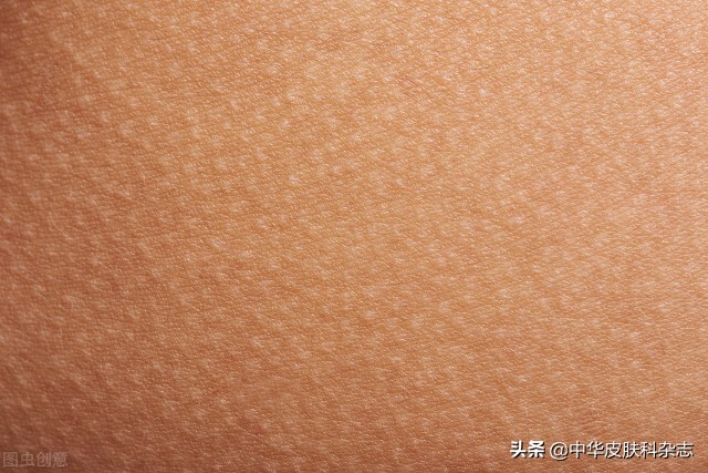 Toad skin disease, pellagra, mangy skin disease, ichthyosis, what are ...