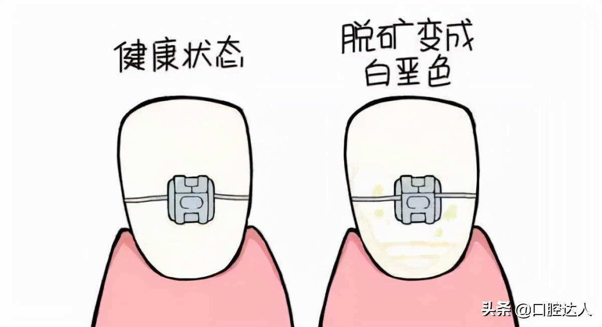 What is tooth demineralization? - iMedia