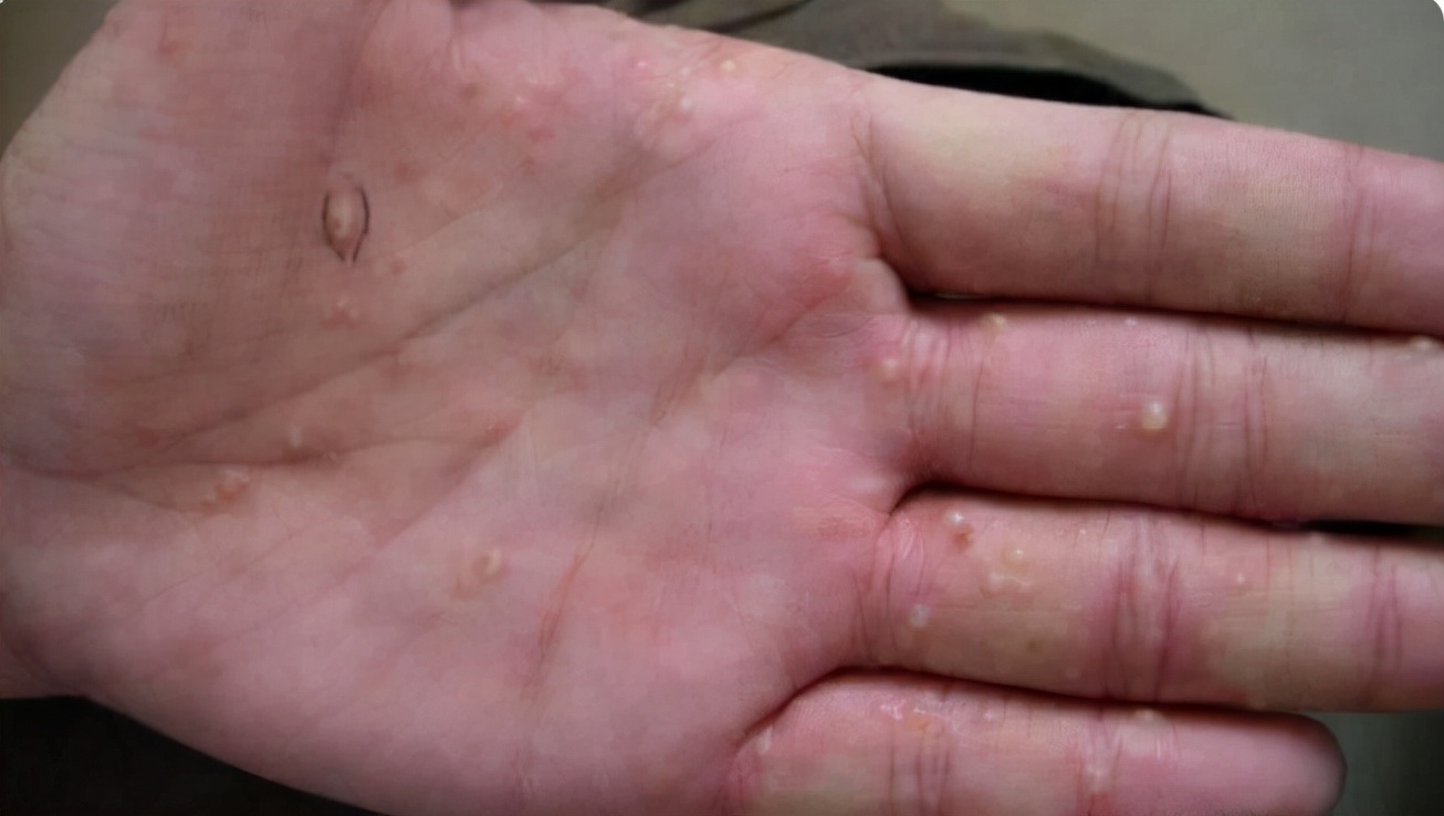 What should I do if the "small blisters" growing on my hands are ...